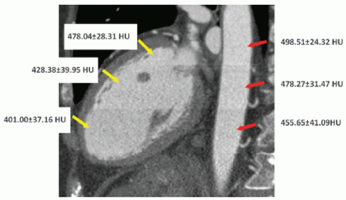 Myocardial Perfusion Imaging: CT Applications | Radiology Key