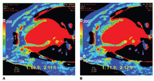 New Dose Reduction Strategies in CT Myocardial Perfusion Imaging ...