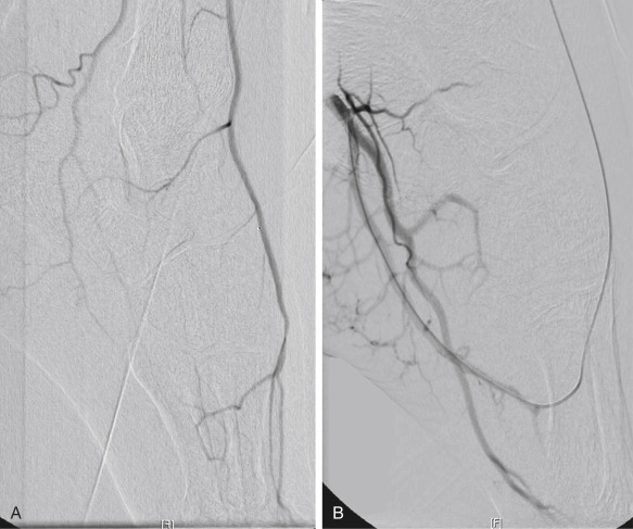 Vascular Anatomy of the Lower Limb | Radiology Key