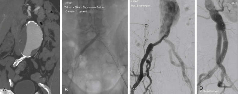 Revascularization: Aortoiliac | Radiology Key