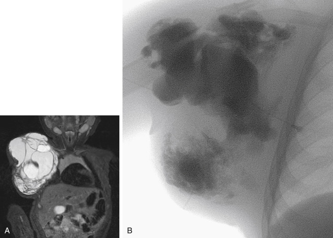 Management of Low-Flow Vascular Malformations | Radiology Key