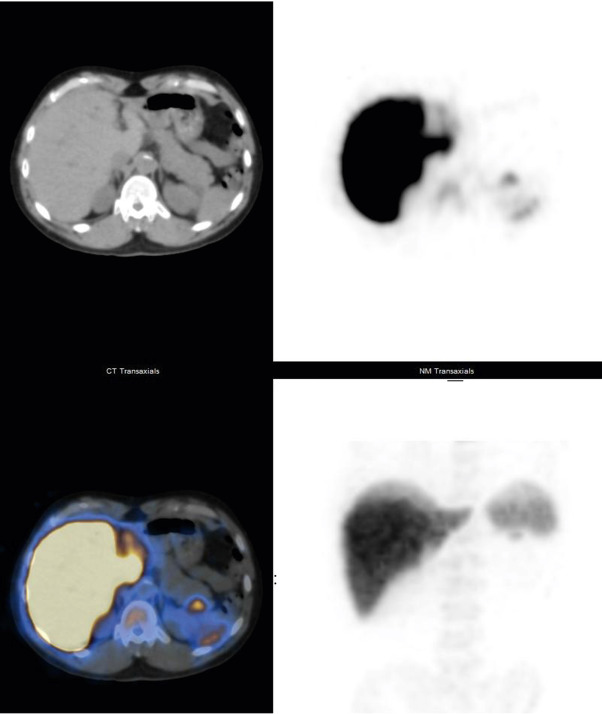 Hepatic, Biliary, and Splenic Scintigraphy | Radiology Key