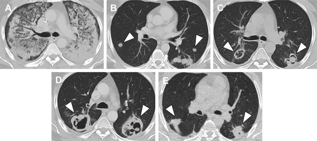 Radiologic Imaging in Large and Medium Vessel Vasculitis | Radiology Key