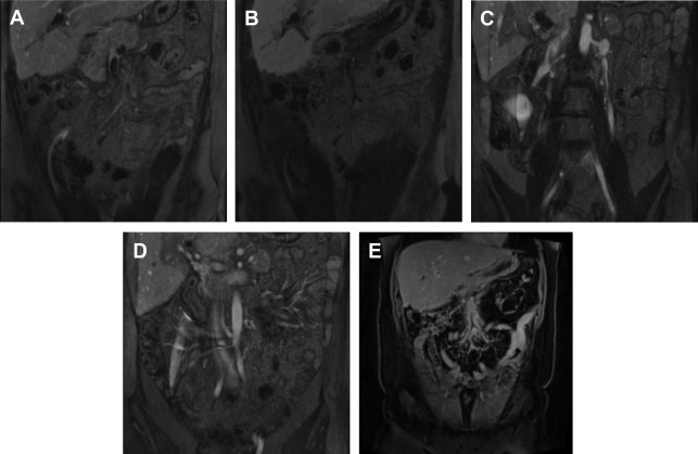 MR Imaging of the Mesenteric Vasculature | Radiology Key