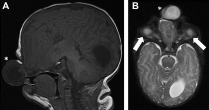 Brain Malformations at All Ages | Radiology Key