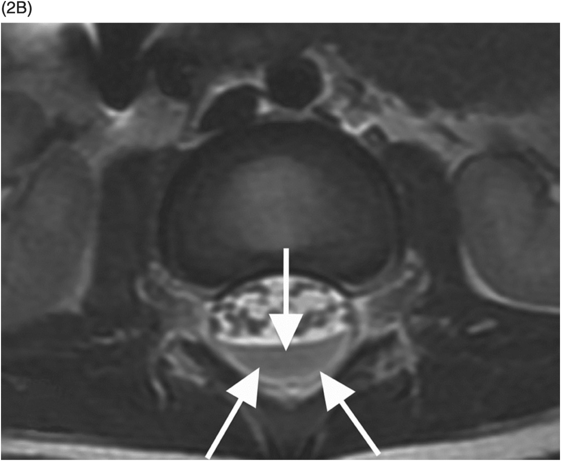 Section 5 – Specifics of Pediatric Spinal Trauma | Radiology Key