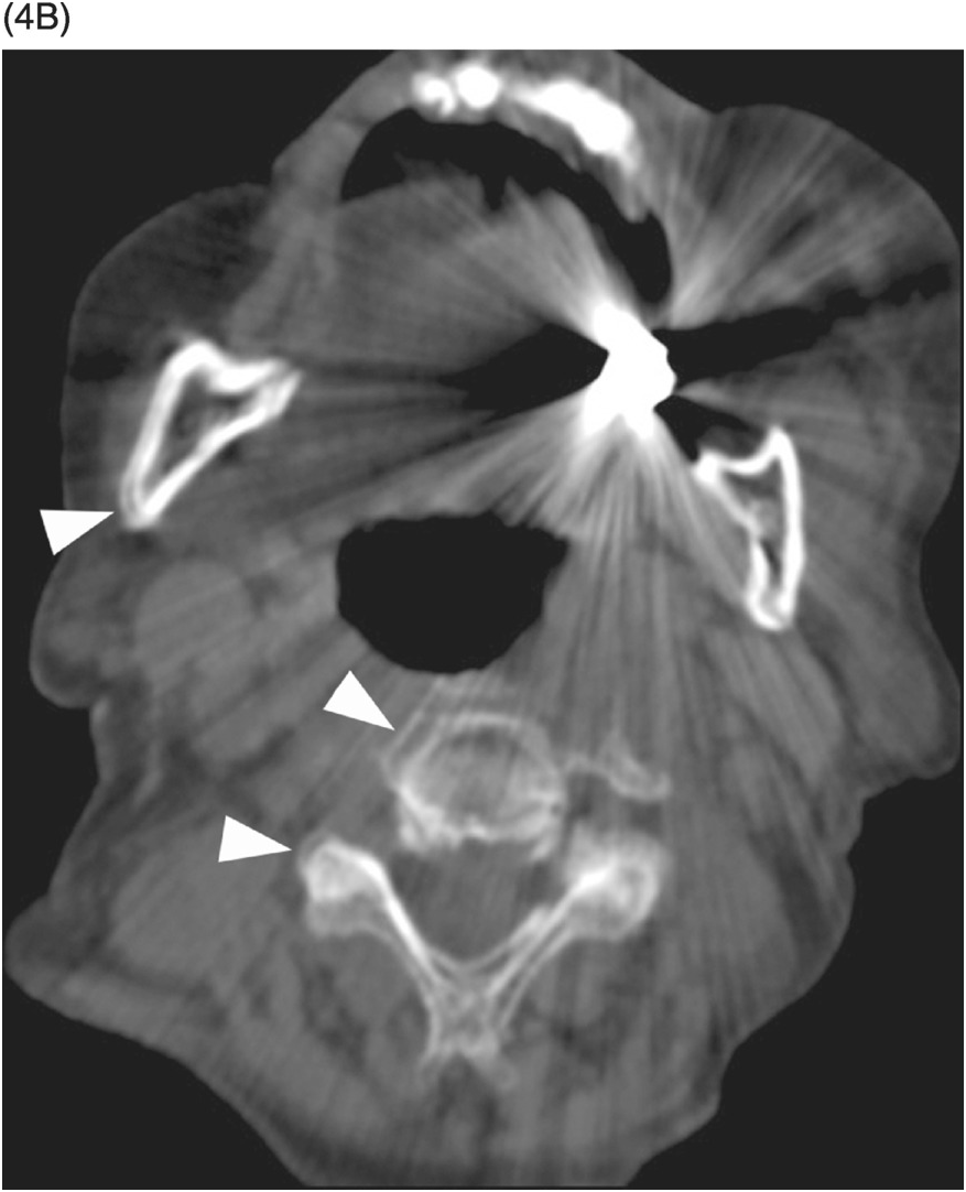 Section 1 – Normal Variants and Mimickers | Radiology Key