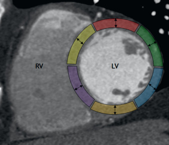 Step-by-Step Analysis of Cardiac Chambers in CT | Radiology Key