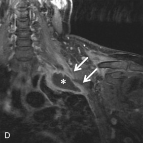 Pulmonary, Mediastinal, Vascular, and Chest Wall MRI | Radiology Key