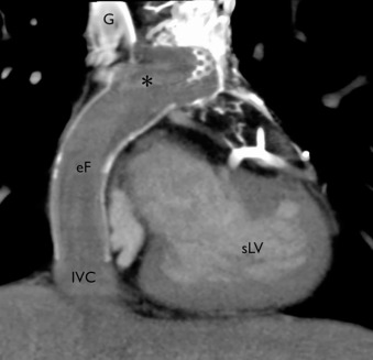 Congenital Heart and Vascular Disease | Radiology Key