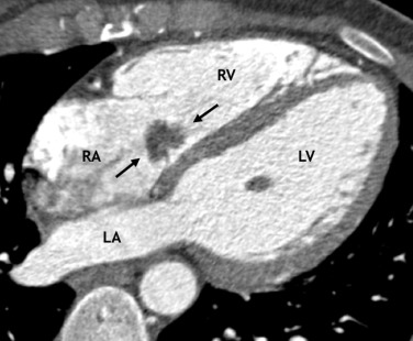 Cardiac Valves | Radiology Key