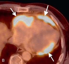 Imaging of the Pericardium | Radiology Key