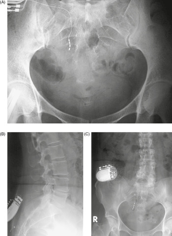 6 – Medical Devices of the Neck and Spine | Radiology Key