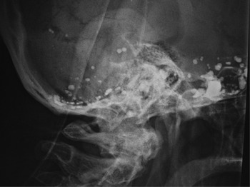10 – Foreign Bodies | Radiology Key