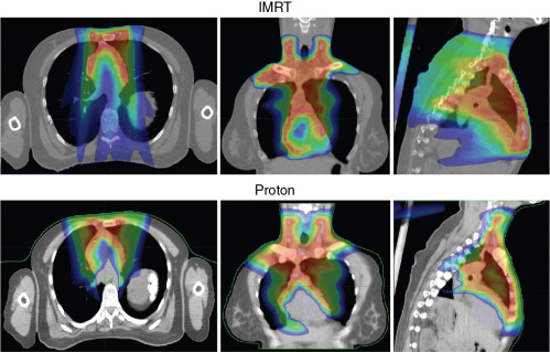 Proton therapy for hematologic malignancies | Radiology Key