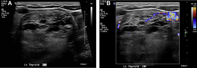 Thyroid Incidentalomas | Radiology Key
