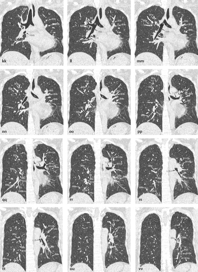 2 Tracheobronchial System | Radiology Key