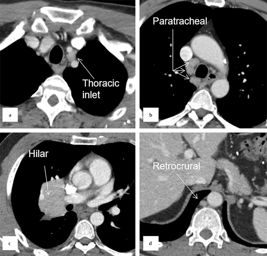 9 Lymphatics and Nerves of the Thorax | Radiology Key