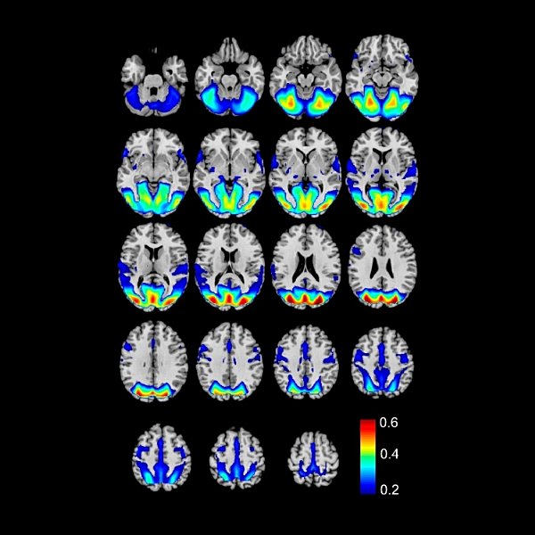 Primary Visual and Visual Association Cortex (Areas 17, 18, 19 ...