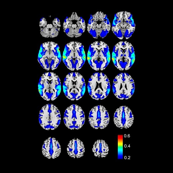 Temporal Cortex (Areas 20, 21, 22) | Radiology Key