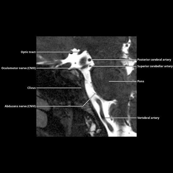 Abducens Nerve (CNVI) | Radiology Key