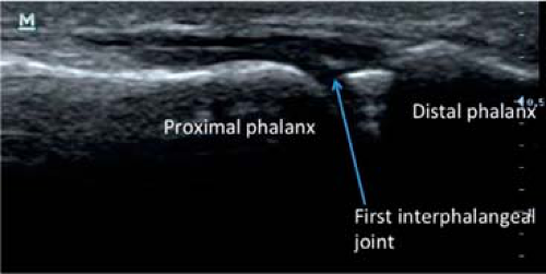 Bunionette | Radiology Key