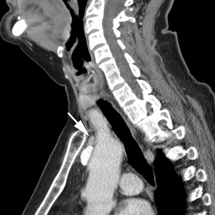 Imaging of the Anterior/Prevascular Mediastinum | Radiology Key