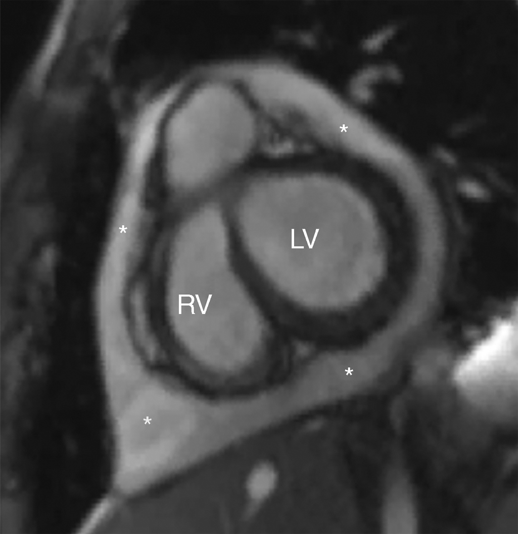 Matters of the heart: Pericarditis | Radiology Key
