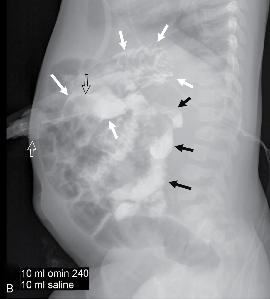 Complications Of Gastrostomy Tube at Aiden Scurry blog