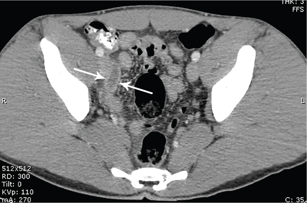 My tummy! Appendicitis | Radiology Key
