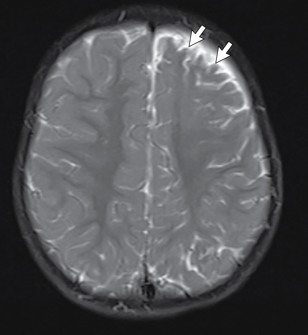 Hard to wake up: Cerebritis | Radiology Key