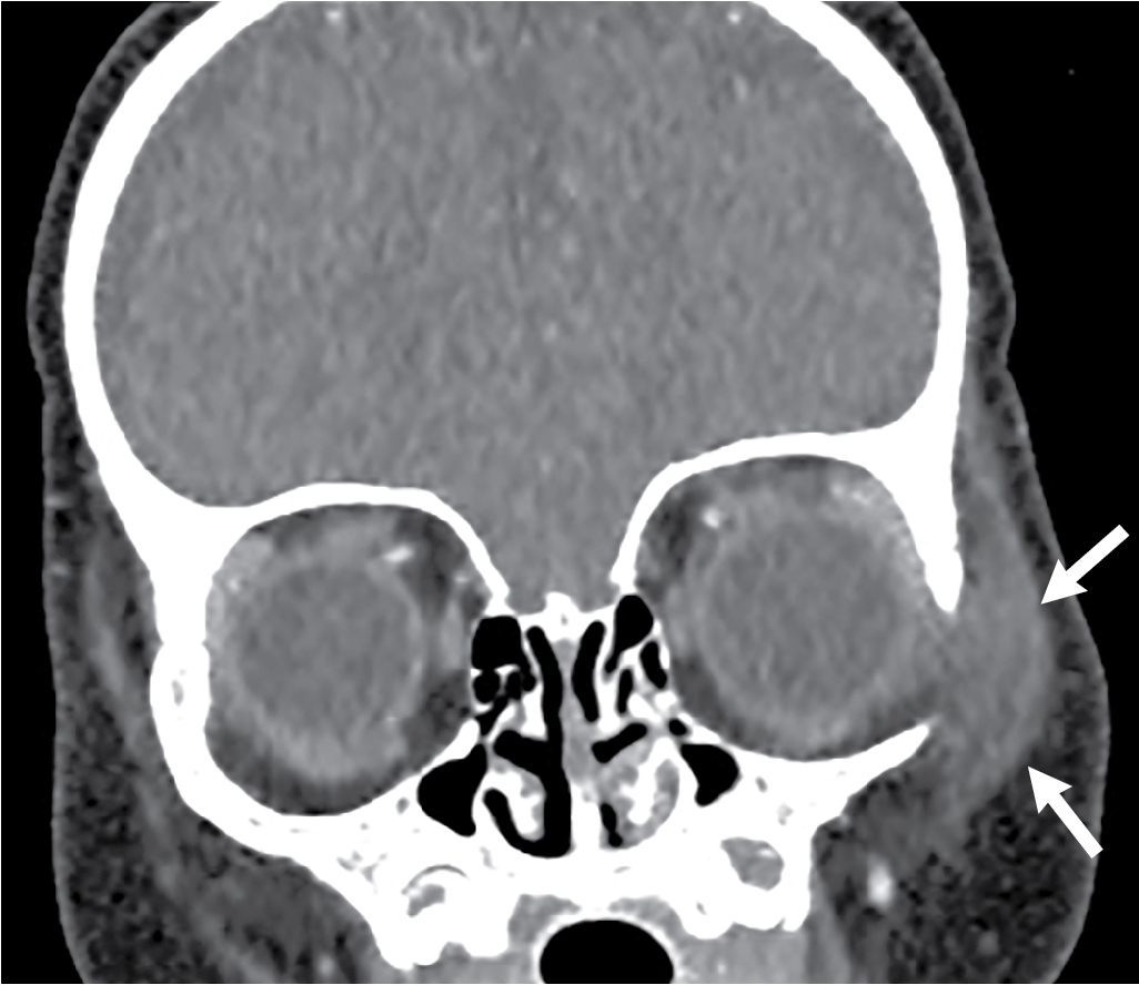 Something in your eye: Periorbital cellulitis | Radiology Key