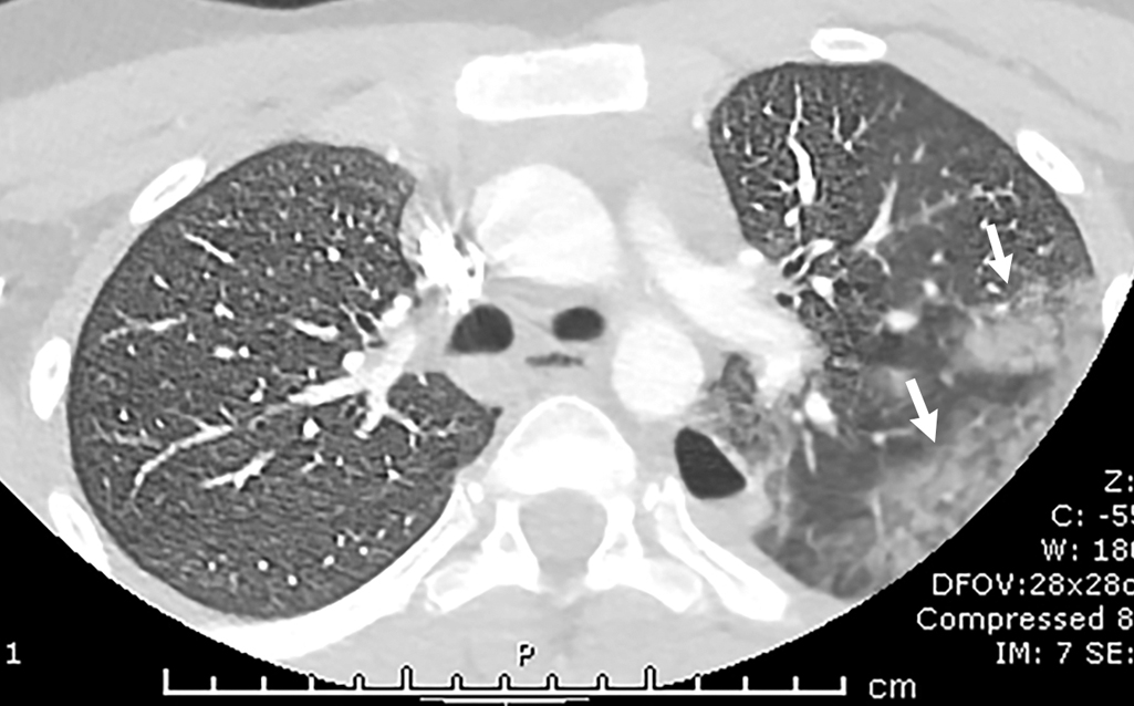 Cruisin’ for a bruisin’: Pulmonary contusion | Radiology Key
