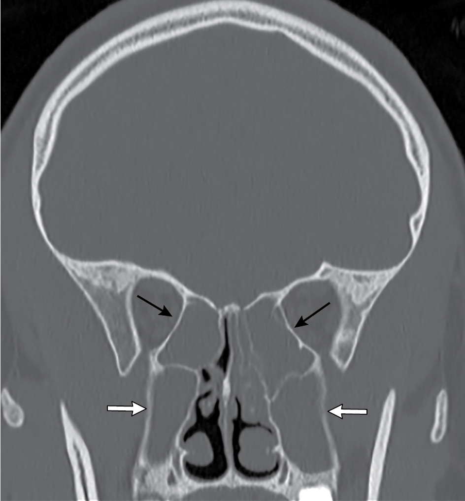 ‘Lil stuffy noses: Sinusitis | Radiology Key