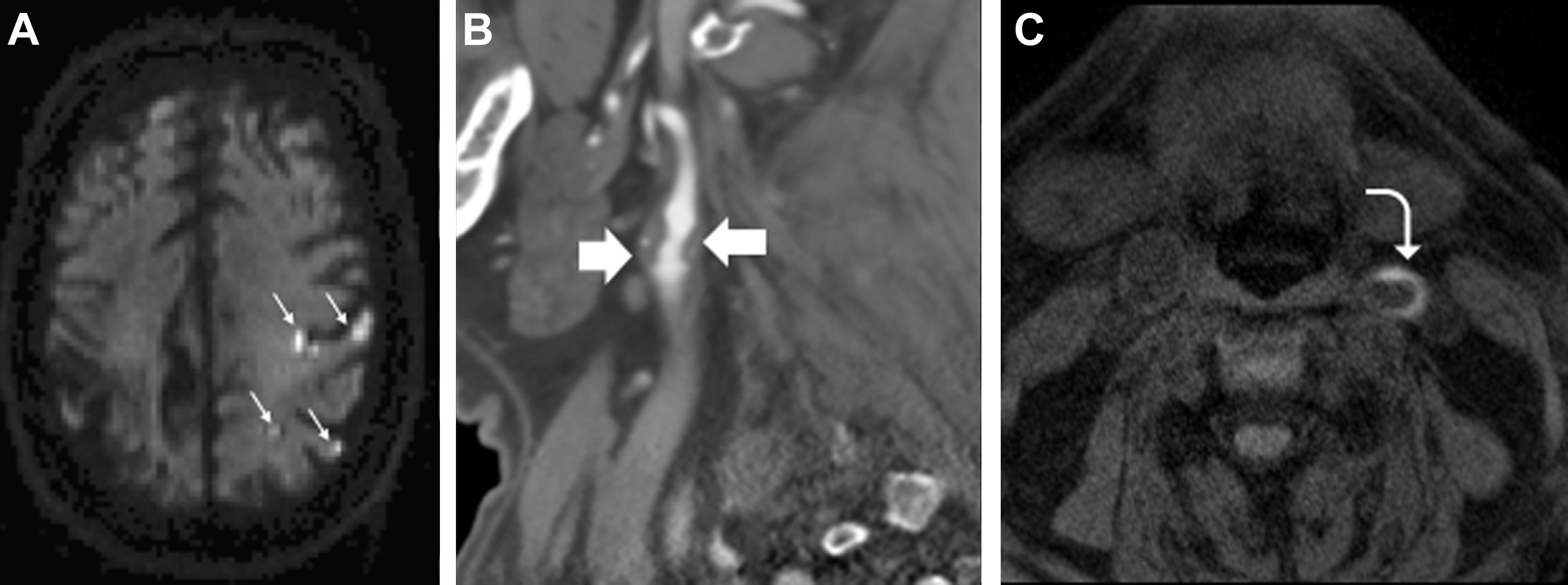 Extracranial Vascular Disease | Radiology Key