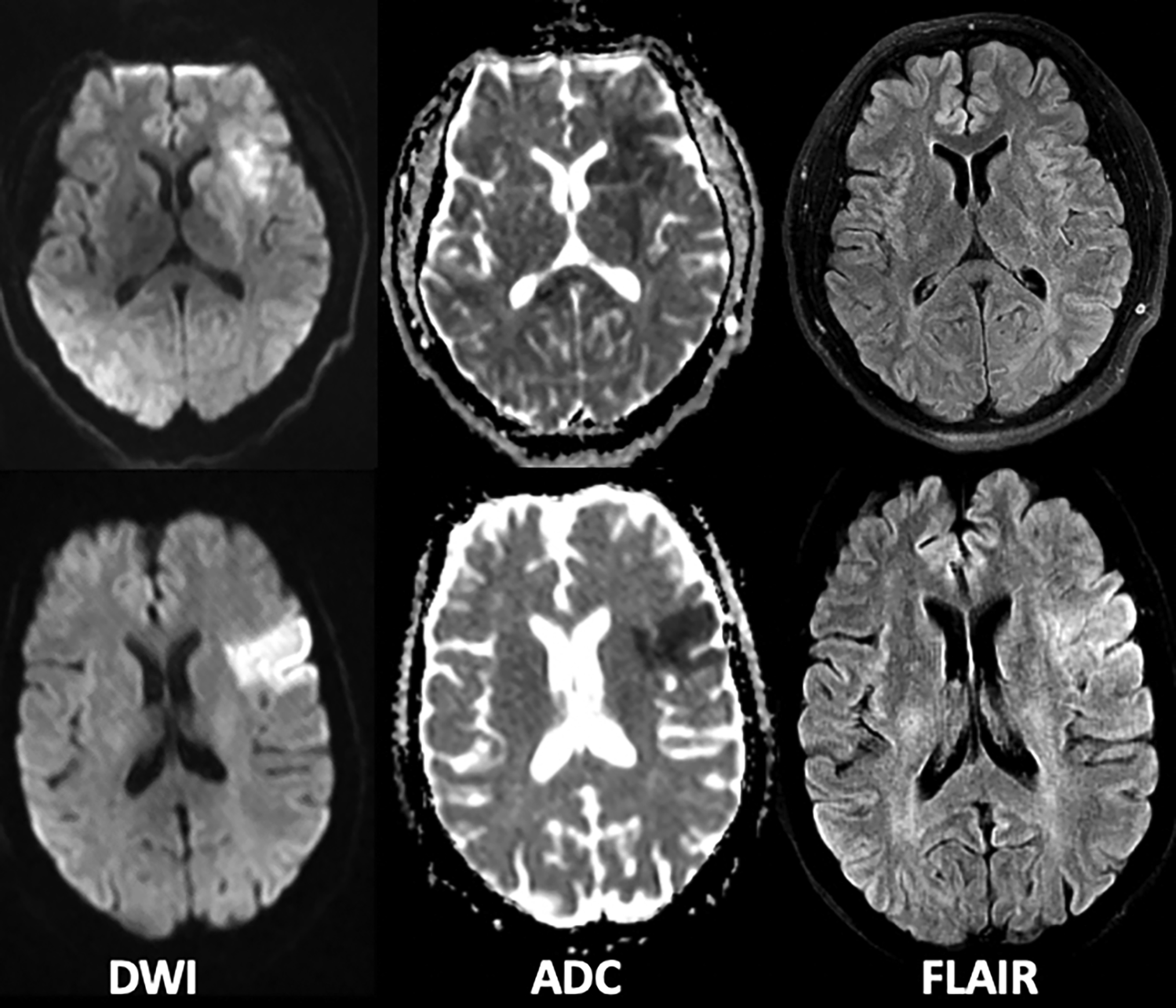 Ischemic Stroke Mri Ischemic Stroke Mri