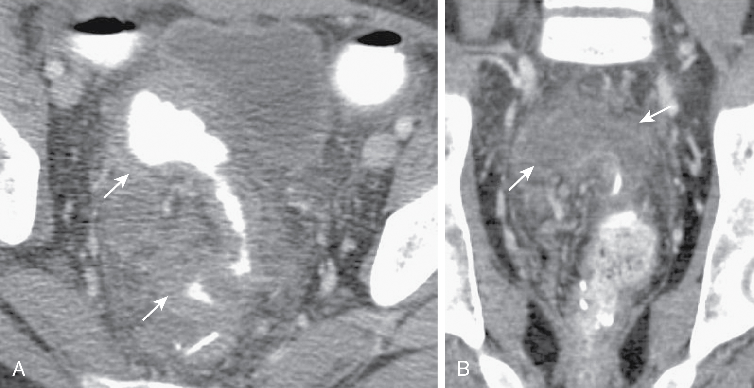 Imaging of the postoperative bowel | Radiology Key