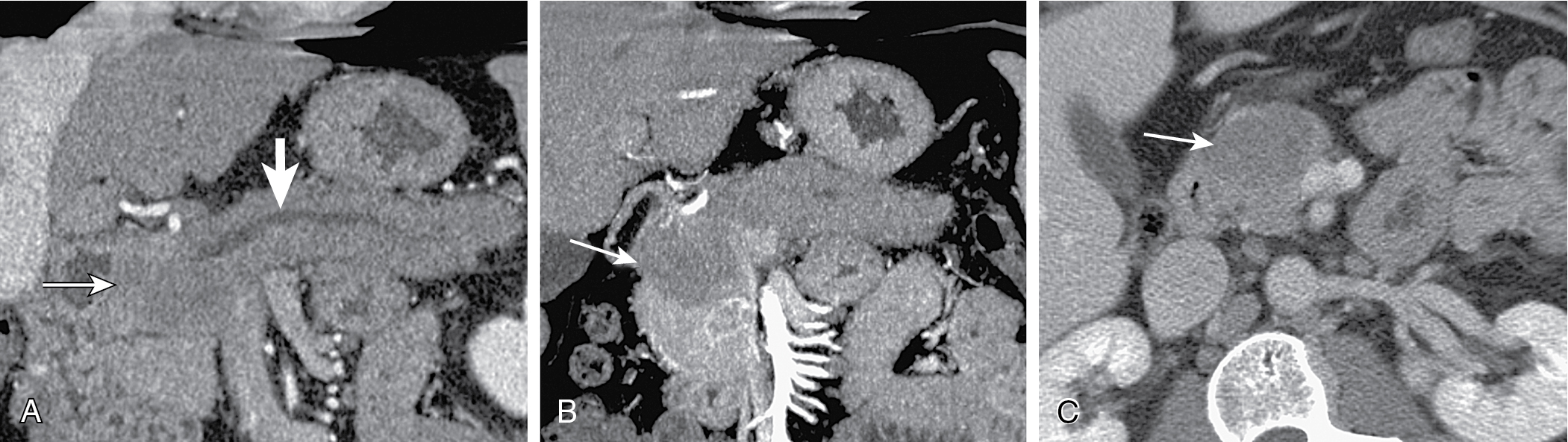 Solid pancreatic masses | Radiology Key