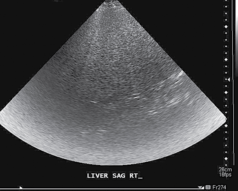 Chronic liver disease | Radiology Key
