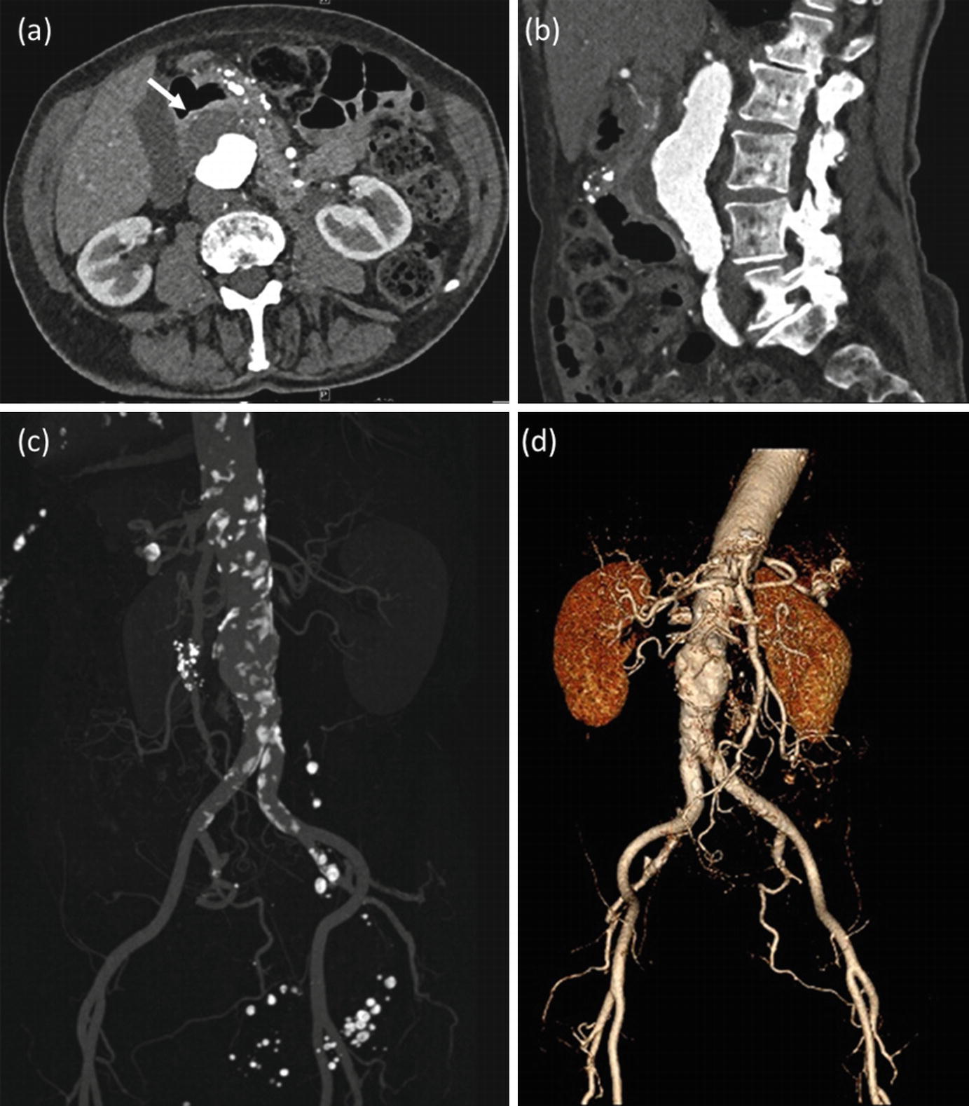 Approaches for Aortic Disease | Radiology Key