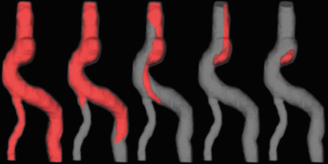 Fluid Dynamics for Evaluating Hemodynamics | Radiology Key