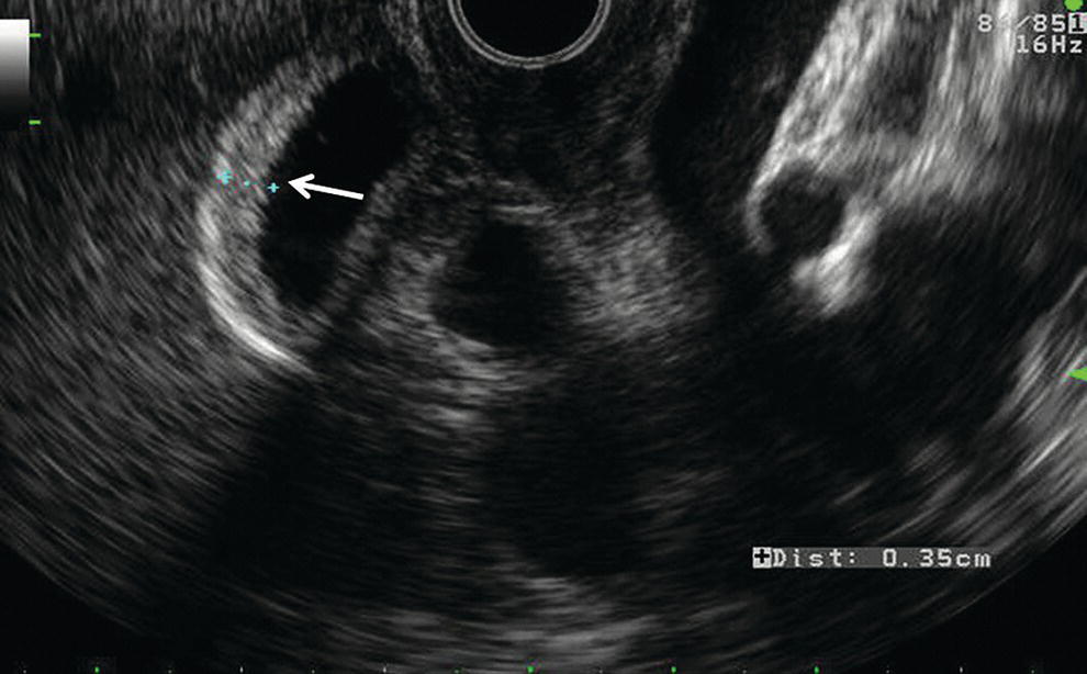 Gallbladder Pathology | Radiology Key