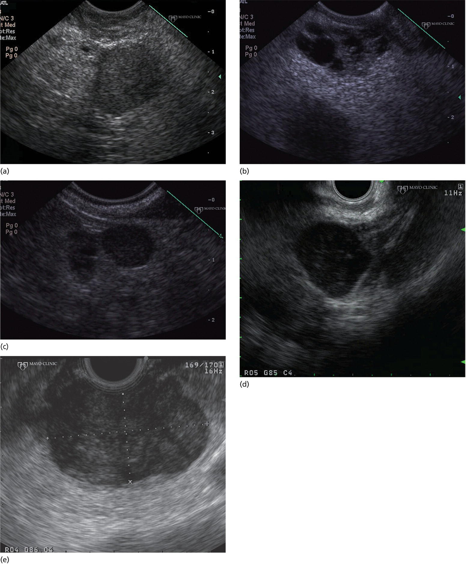 Pancreatic Malignancy (Non‐adenocarcinoma) | Radiology Key