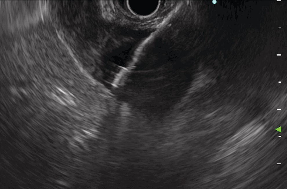 How to do EUS Gallbladder Drainage | Radiology Key