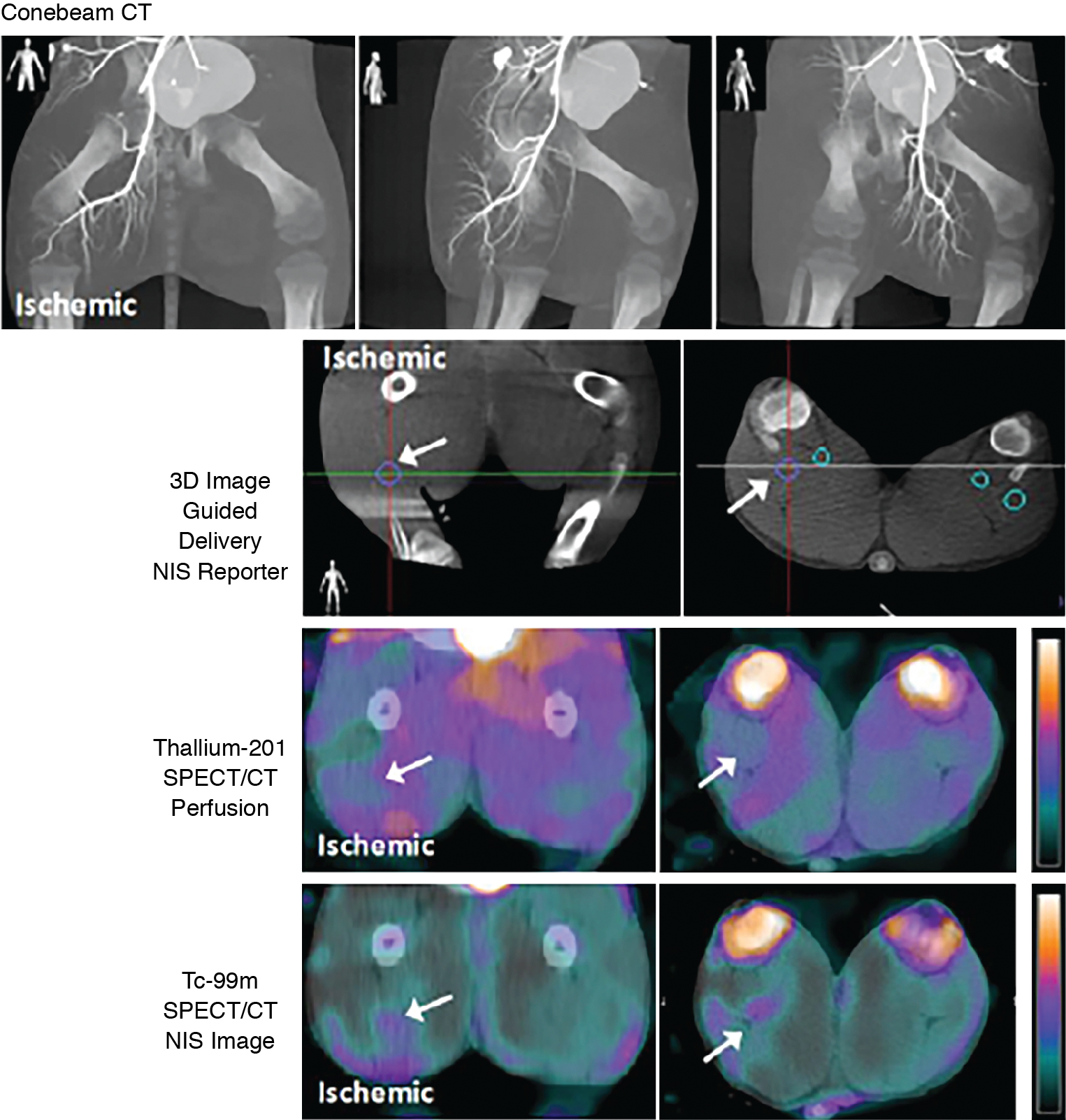 Peripheral arterial disease | Radiology Key