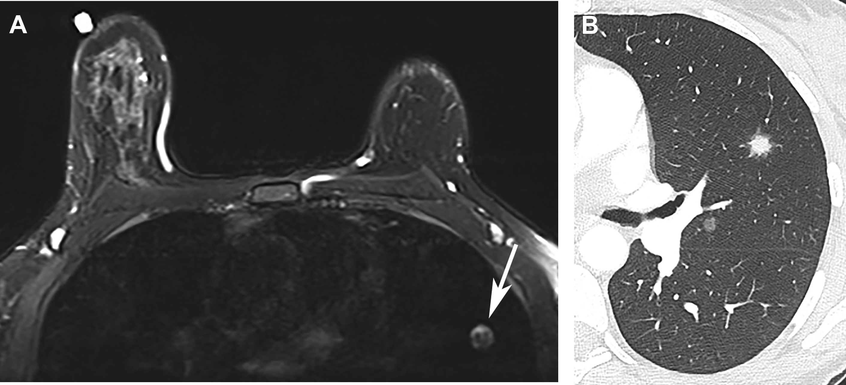 Incidental Lung Nodules On Cross sectional Imaging Radiology Key Incidental Lung Nodules On Cross sectional Imaging Radiology Key