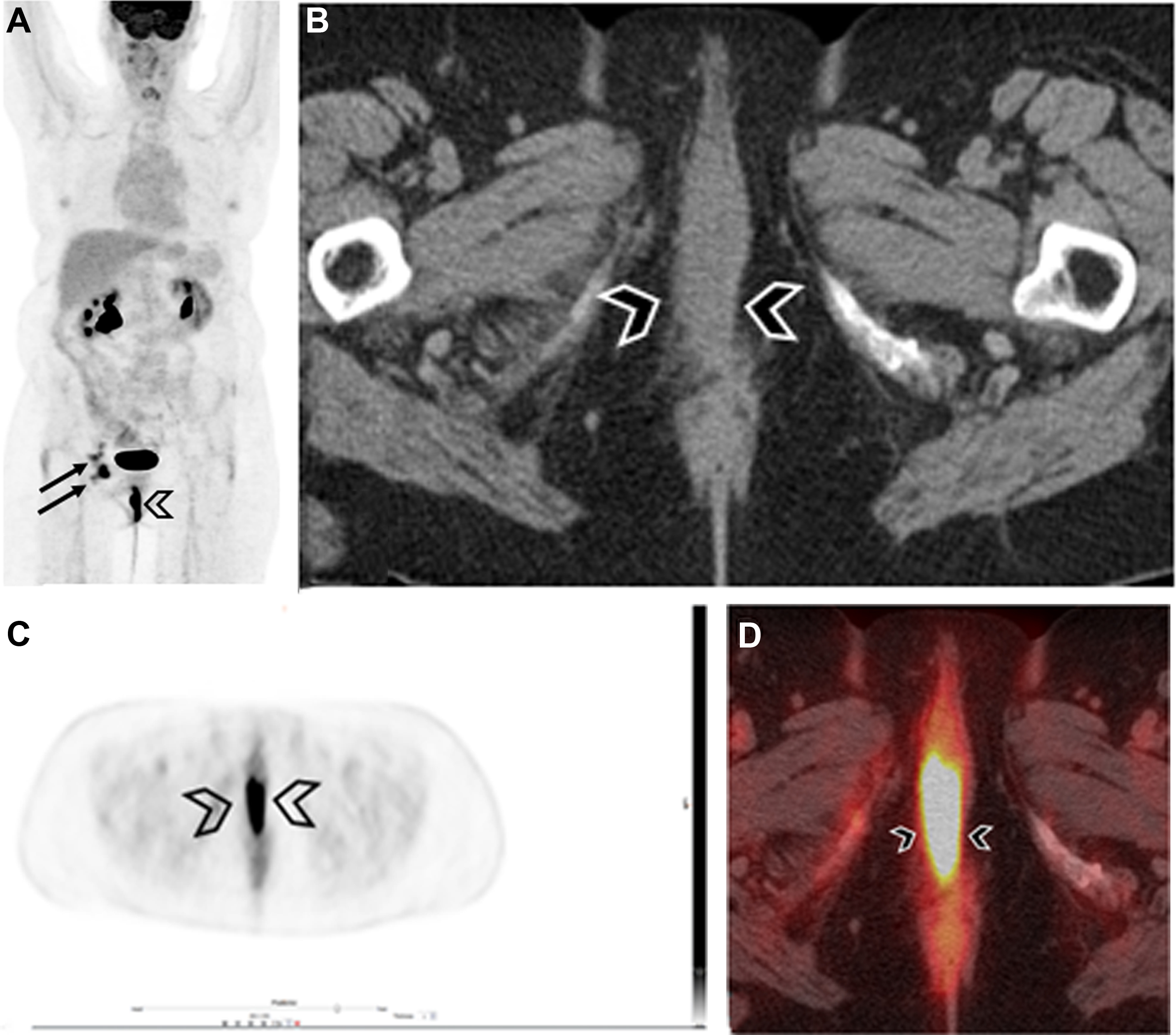 PET Imaging for Gynecologic Malignancies | Radiology Key