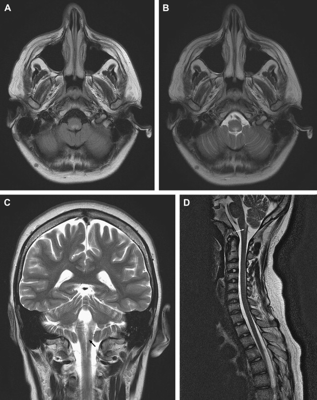 Diagnosing Neuromyelitis Optica | Radiology Key