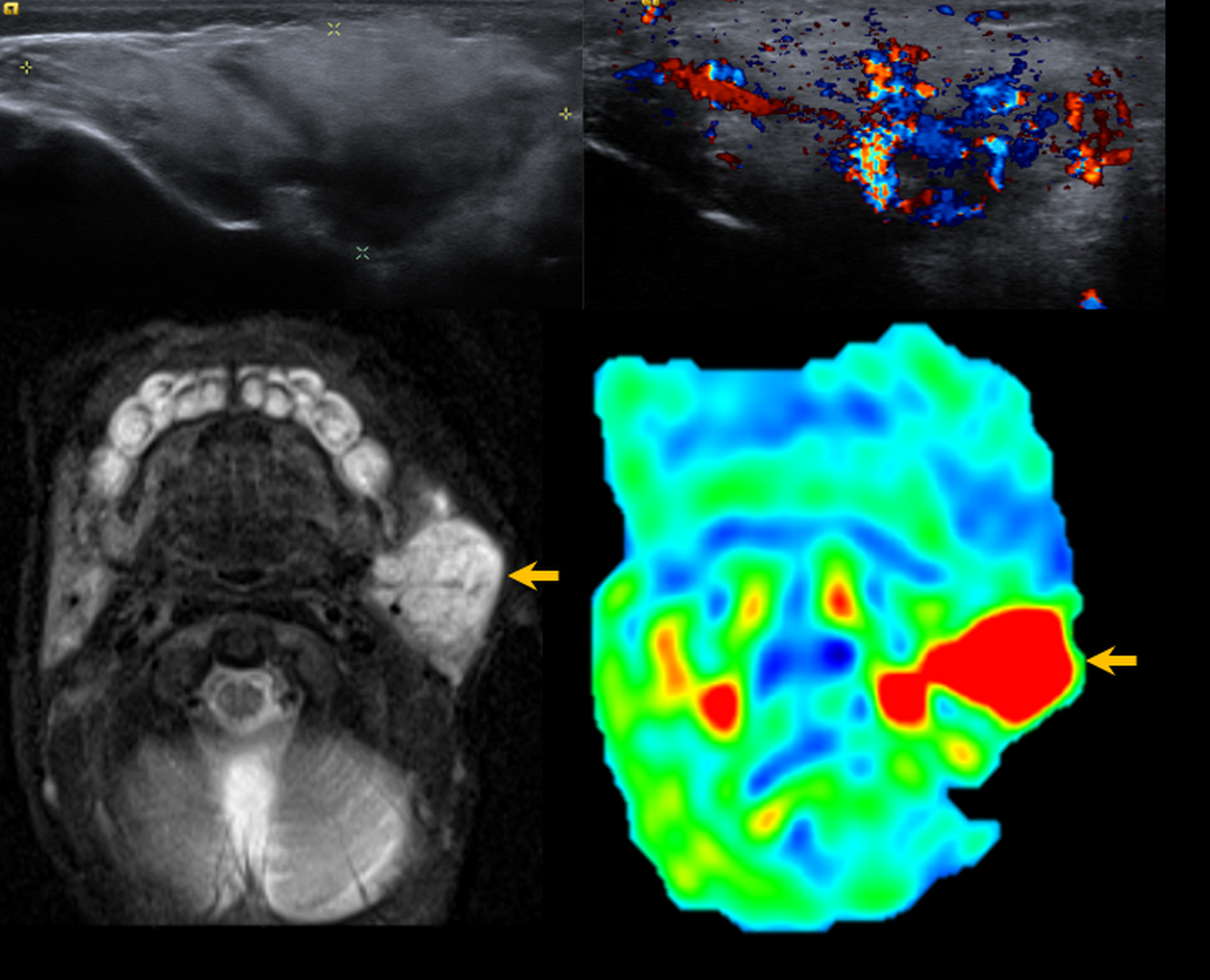 Pediatric Neck Masses | Radiology Key