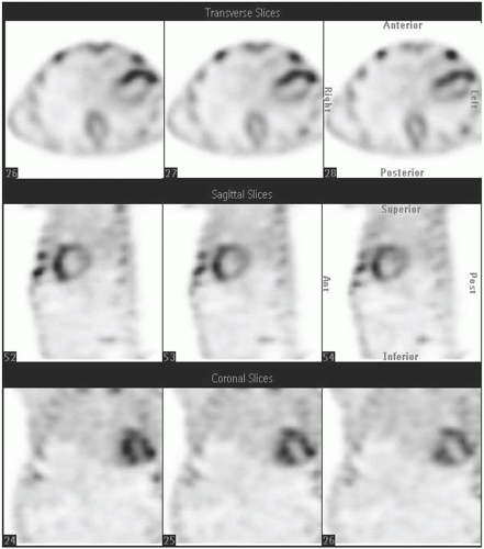 Cardiovascular Nuclear Medicine | Radiology Key